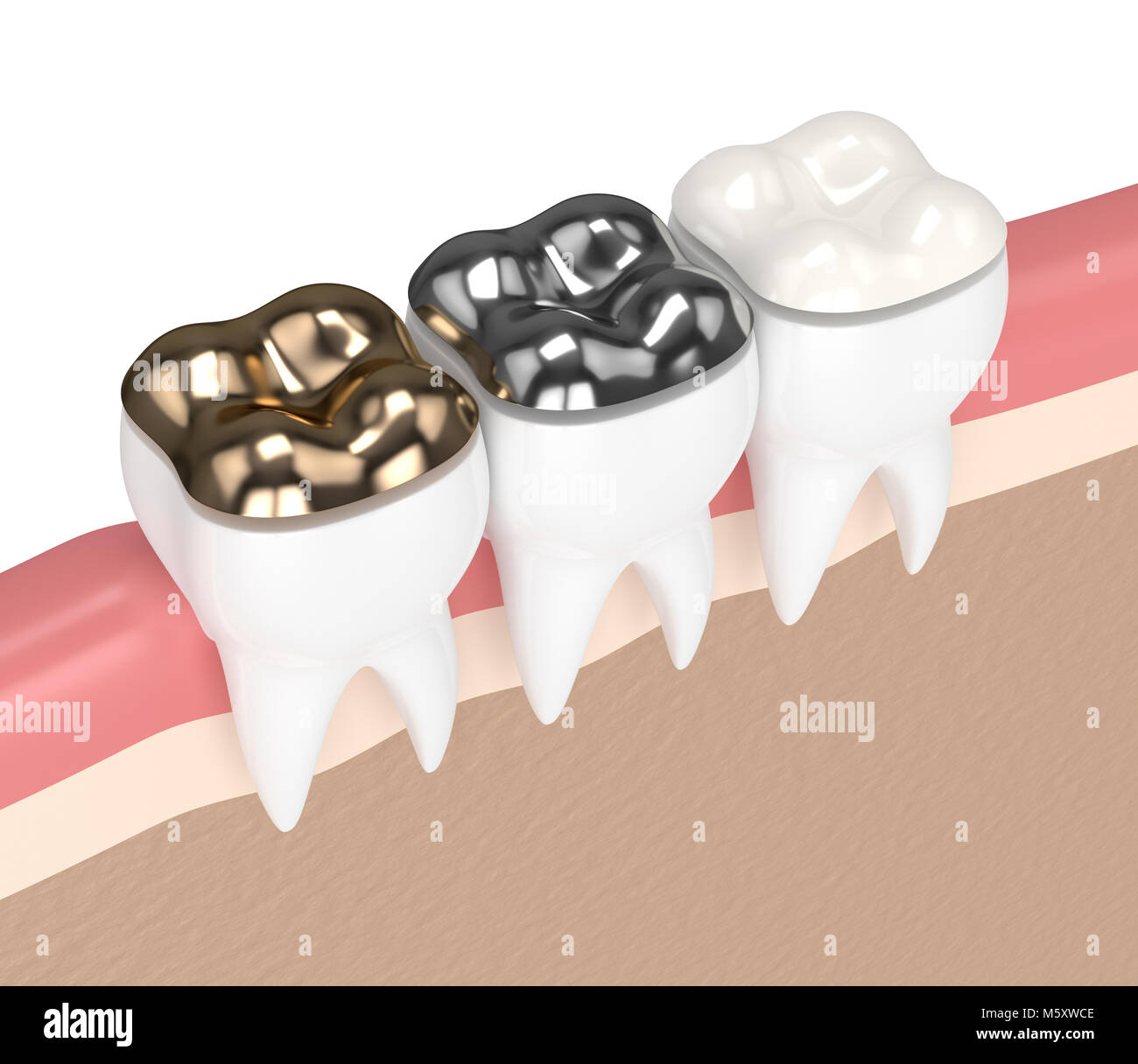 3d render of teeth with gold, amalgam and composite onlay dental ...