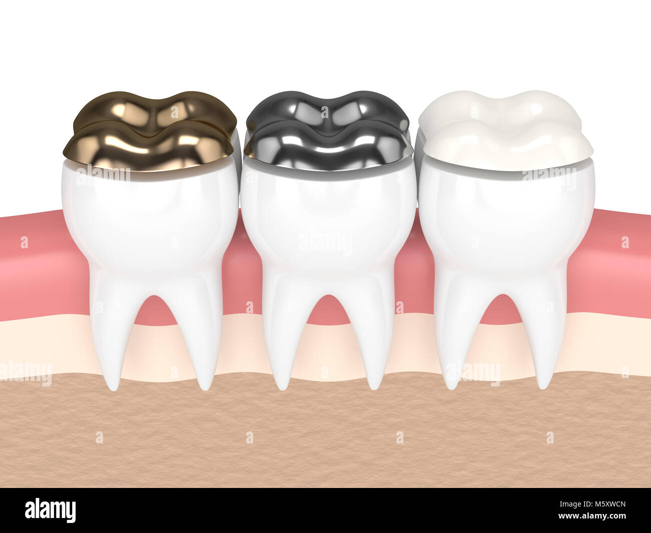 3d render of teeth with gold, amalgam and composite onlay dental ...