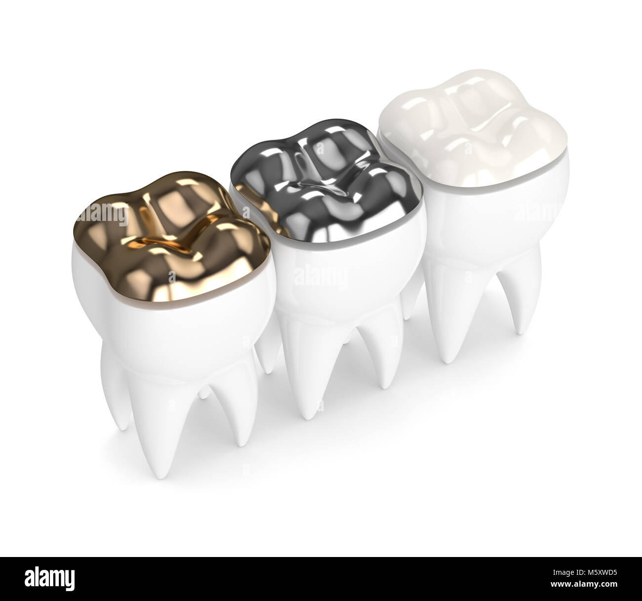 3d render of teeth with gold, amalgam and composite onlay dental ...