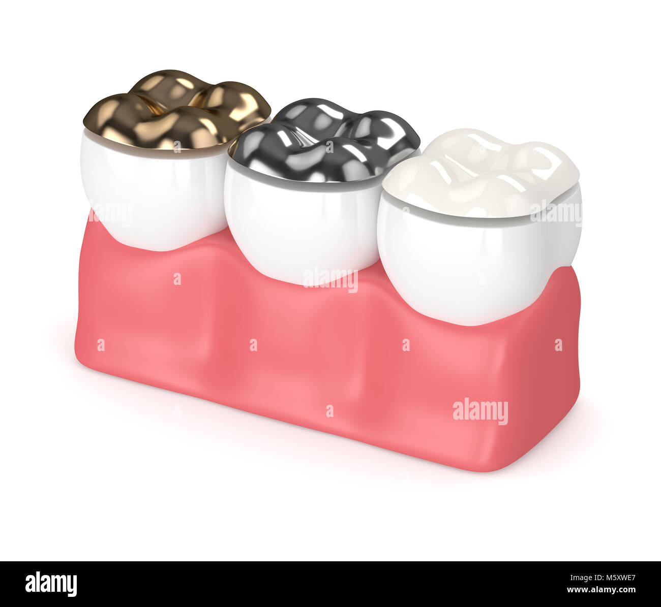 3d render of teeth with gold, amalgam and composite onlay dental ...
