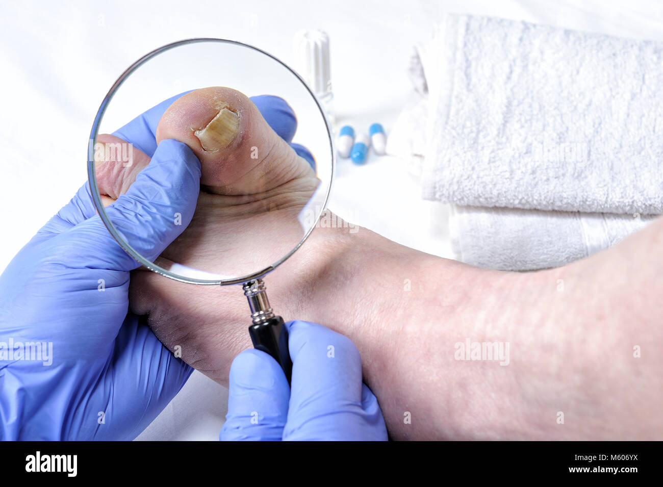 Dermatologist doctor visits the nails of a patient affected by ...