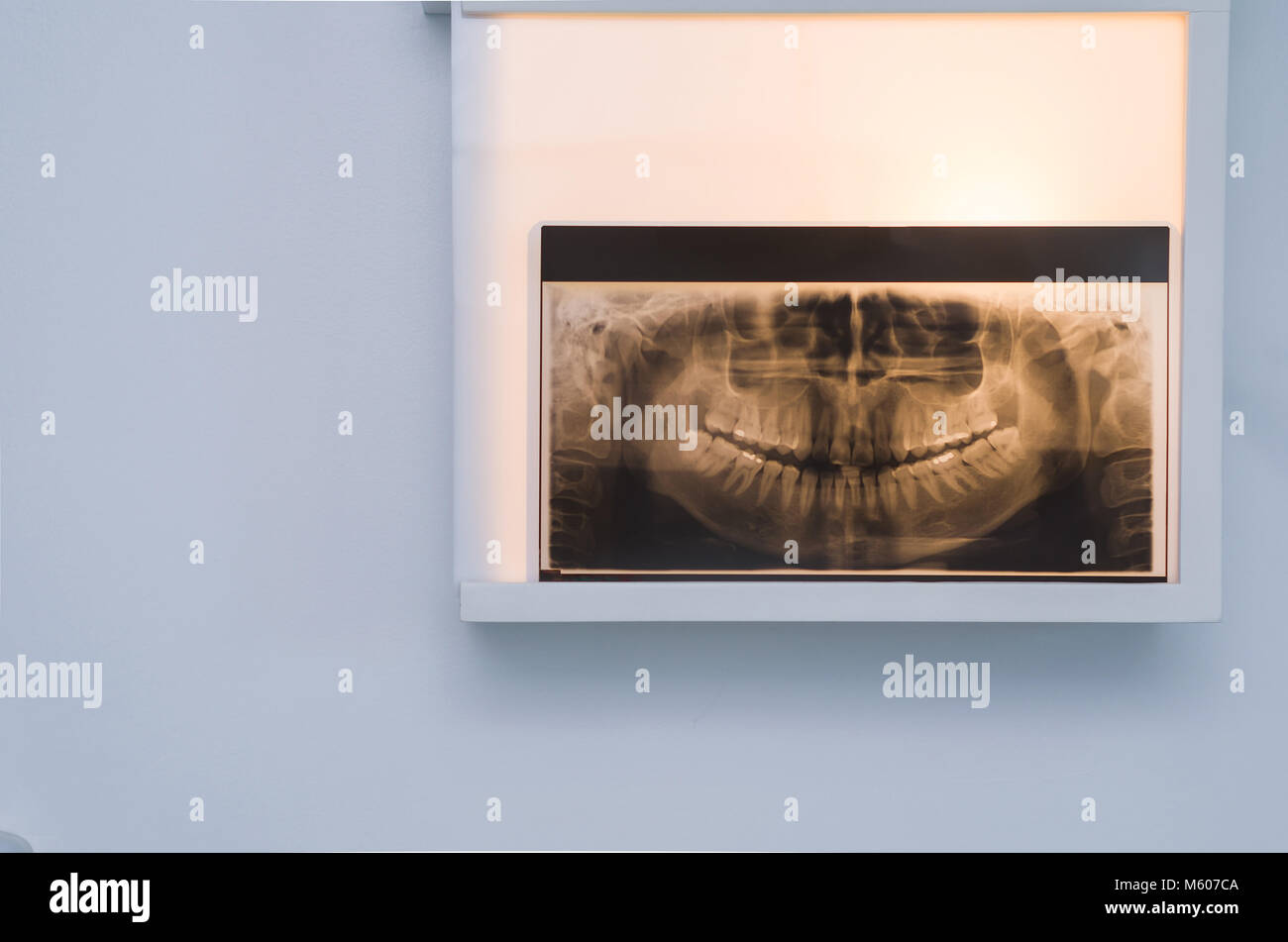 Analyzing dental x-ray, tooth x-ray in viewer on the wall Stock Photo ...