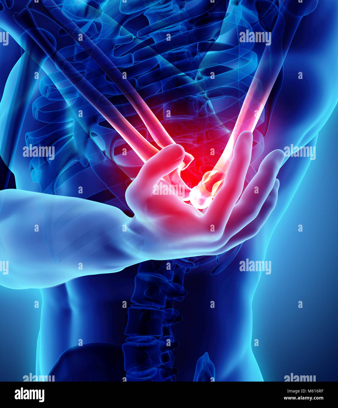 3d illustration of human elbow injury, medical concept Stock Photo - Alamy