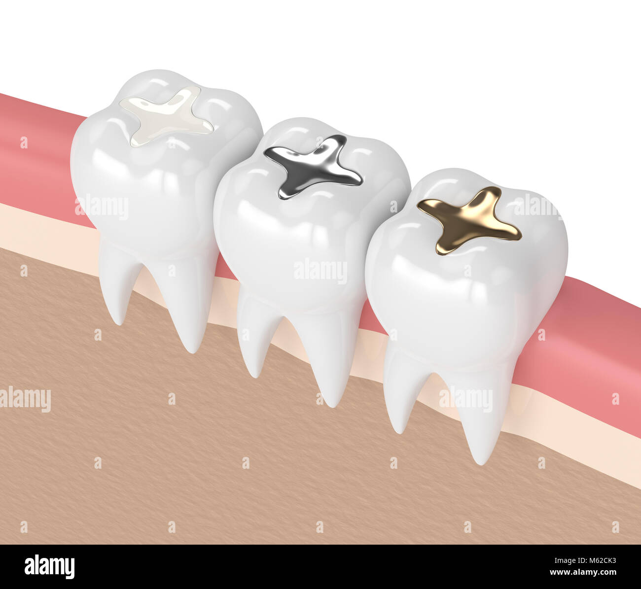 3d render of teeth with gold, amalgam and composite inlay dental ...