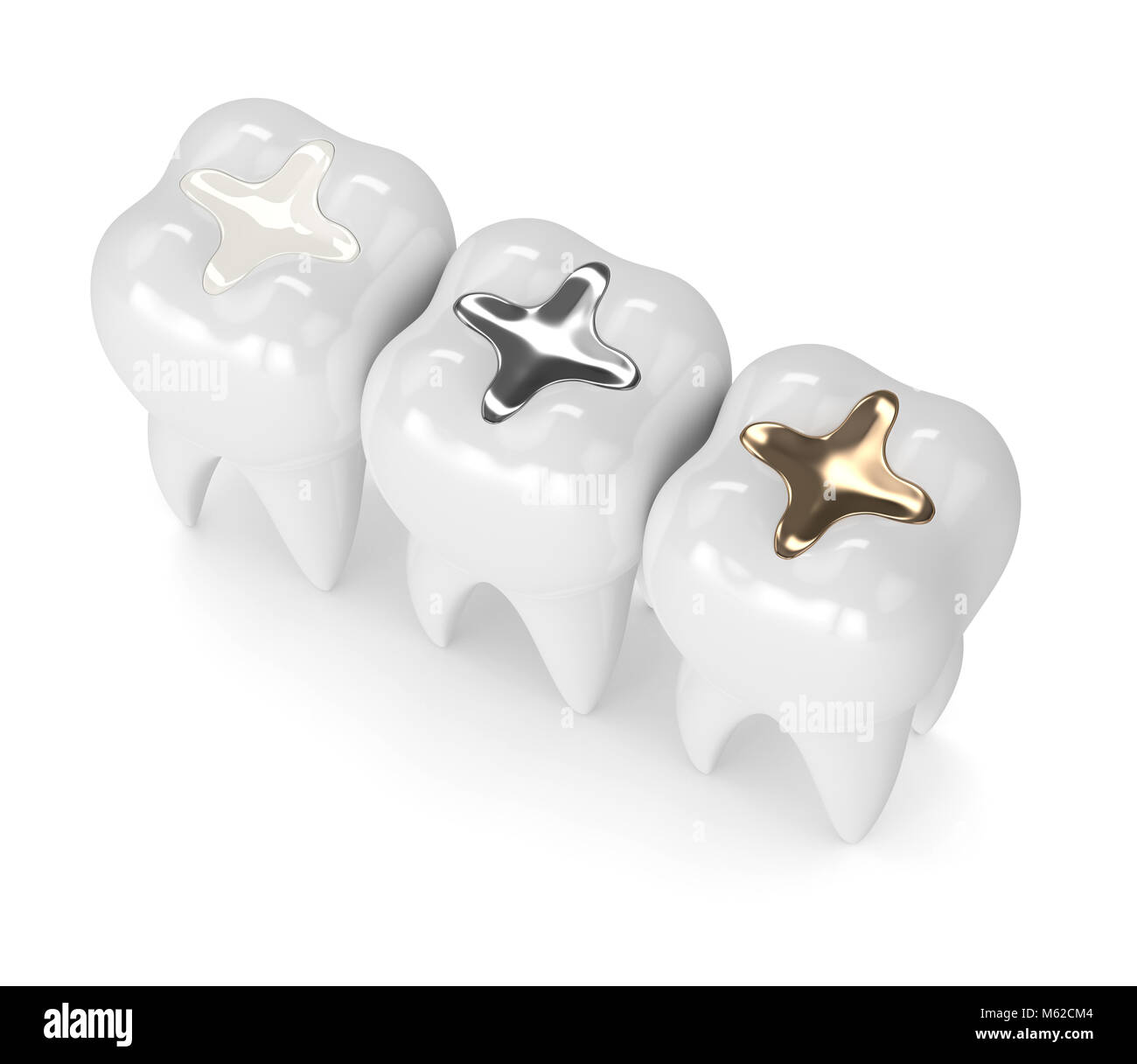 3d render of teeth with gold, amalgam and composite inlay dental ...