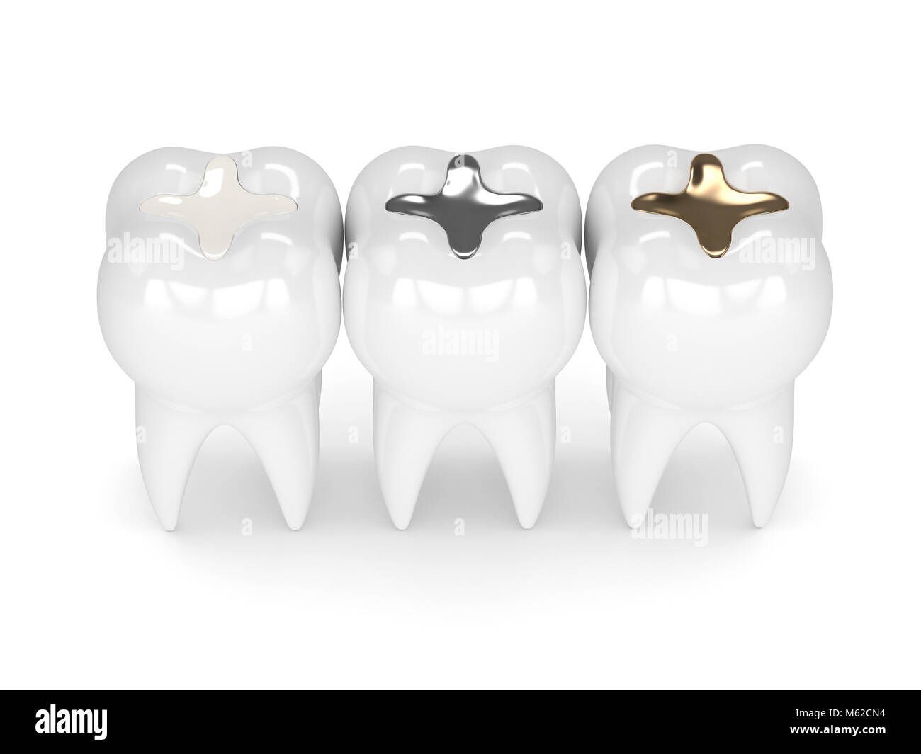 3d render of teeth with gold, amalgam and composite inlay dental ...