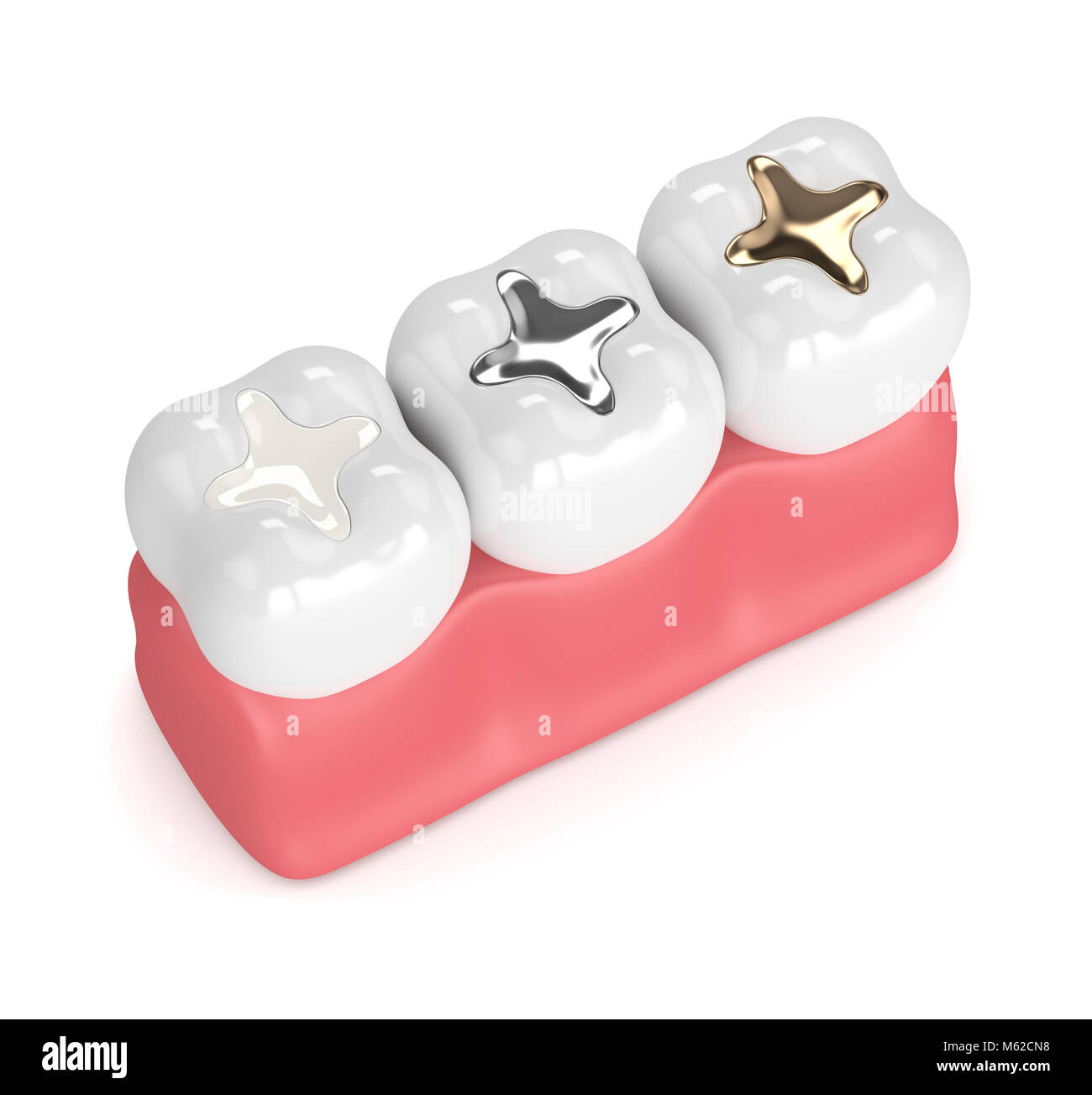 3d render of teeth with gold, amalgam and composite inlay dental ...