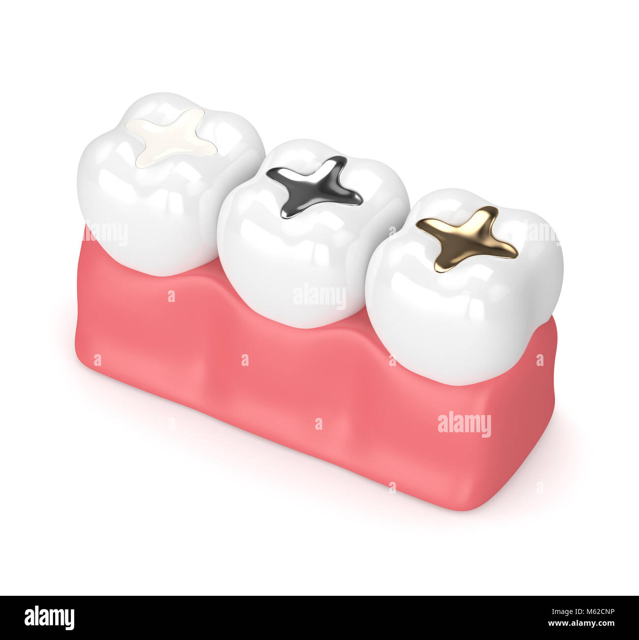 3d render of teeth with gold, amalgam and composite inlay dental ...