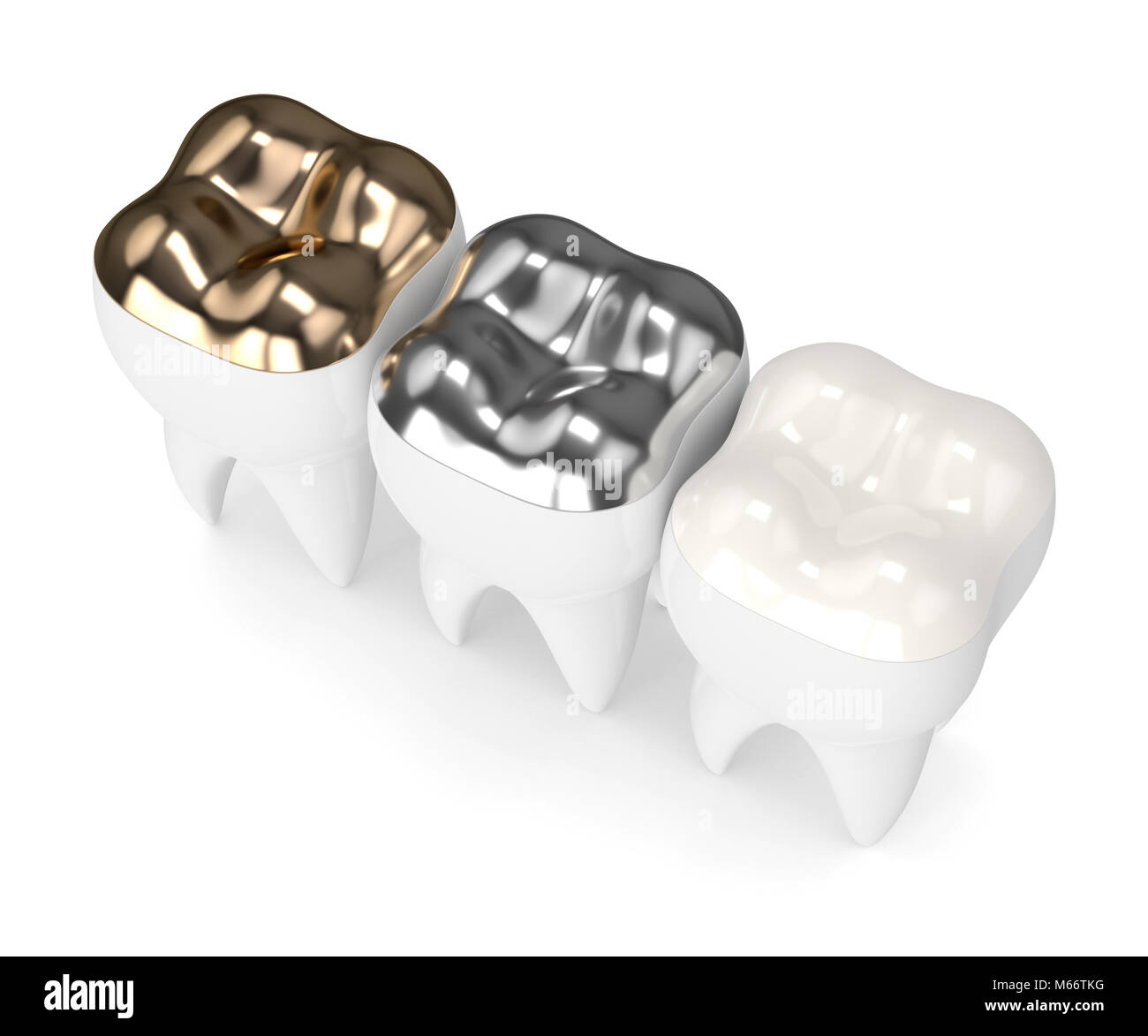 3d render of teeth with gold, amalgam and composite onlay dental ...
