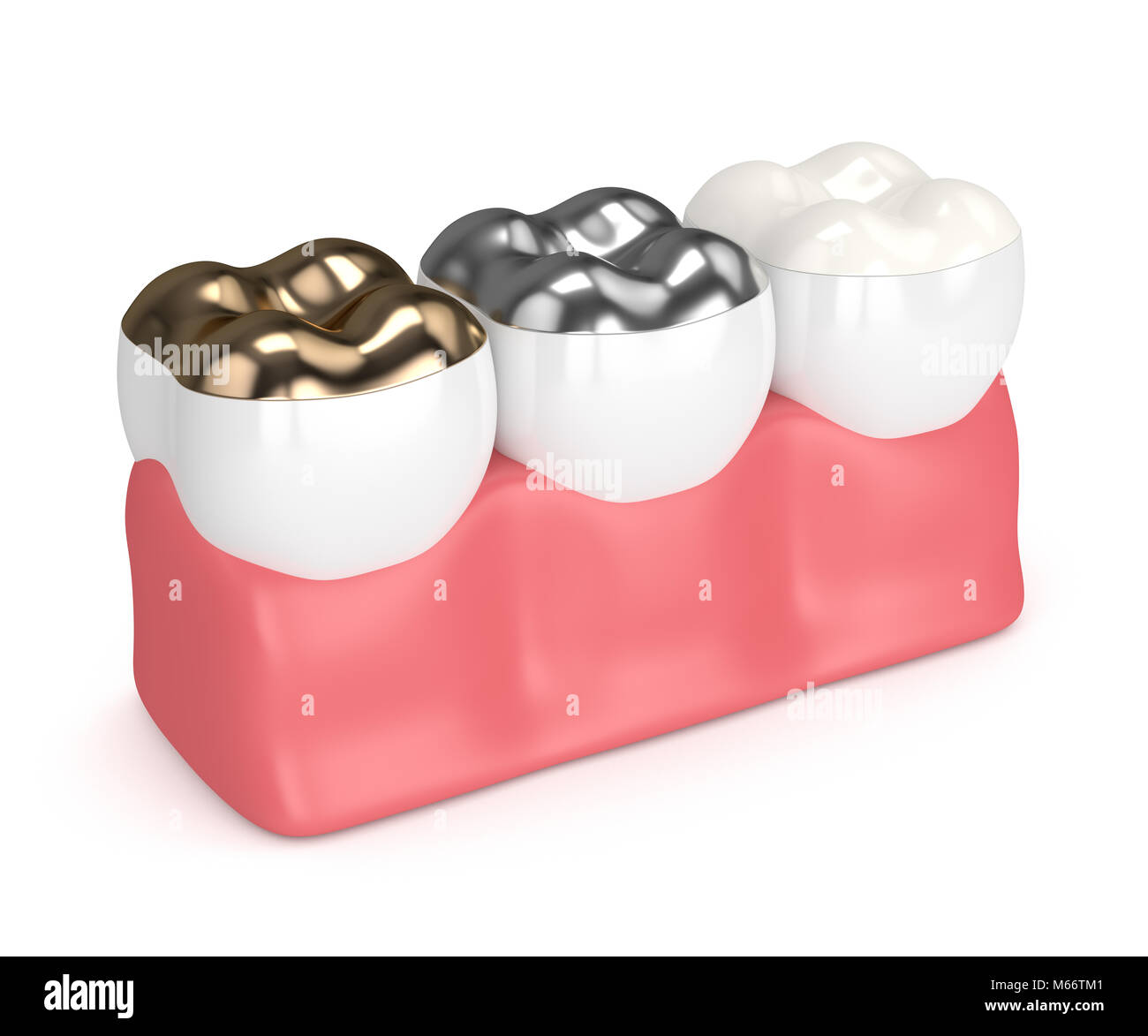 3d render of teeth with gold, amalgam and composite onlay dental ...