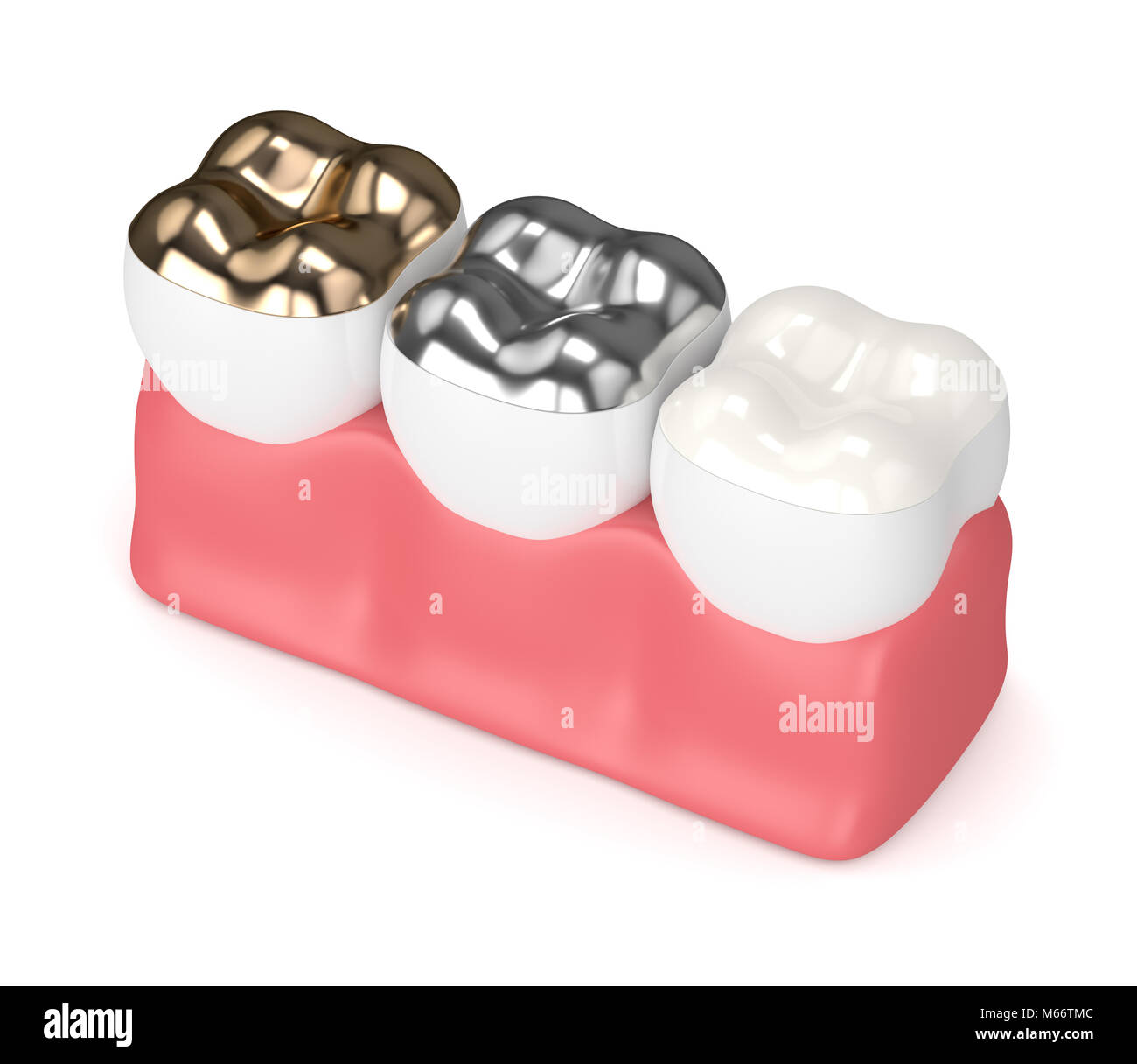 3d render of teeth with gold, amalgam and composite onlay dental ...