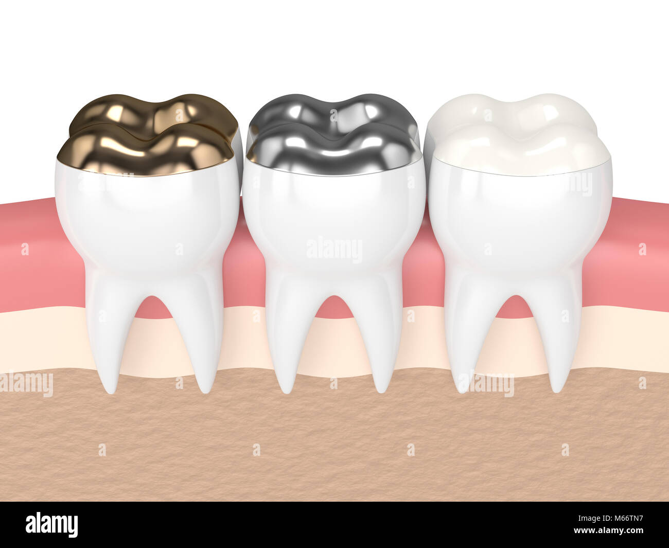 3d render of teeth with gold, amalgam and composite onlay dental ...
