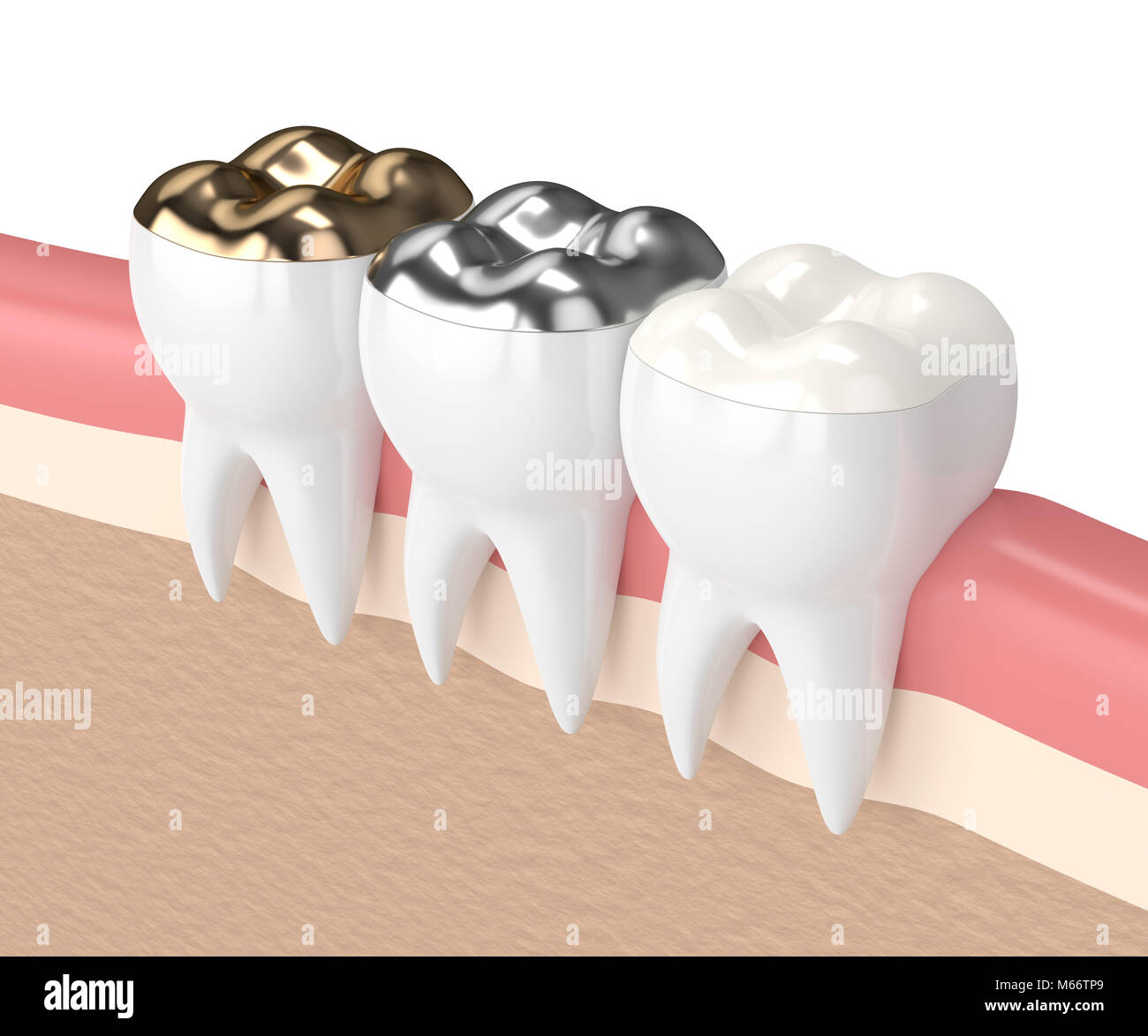 3d render of teeth with gold, amalgam and composite onlay dental ...