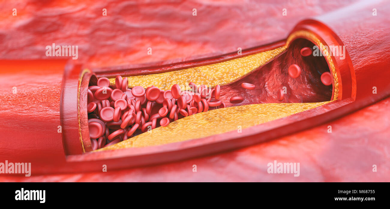 Atherosclerosis hi-res stock photography and images - Alamy