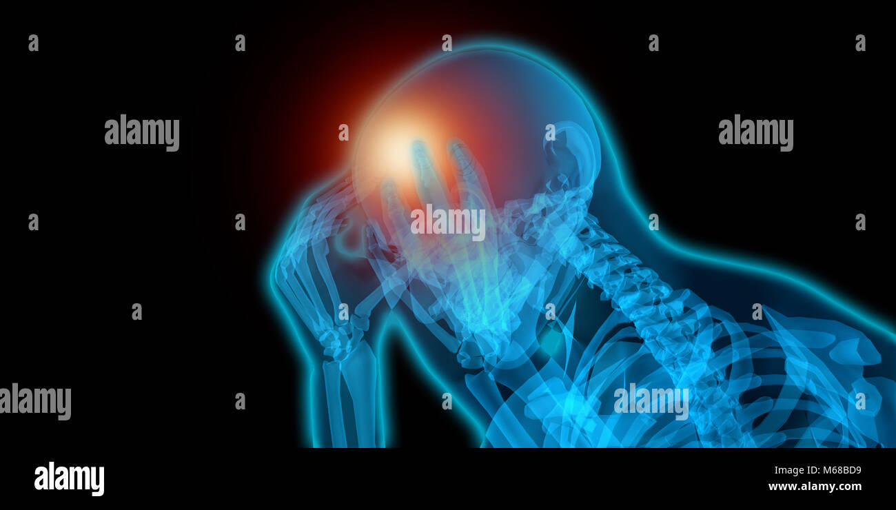 3d migraine headache xray hi-res stock photography and images - Alamy