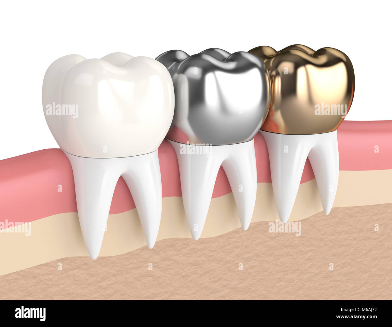 3d render of teeth with gold, amalgam and composite dental crown in ...