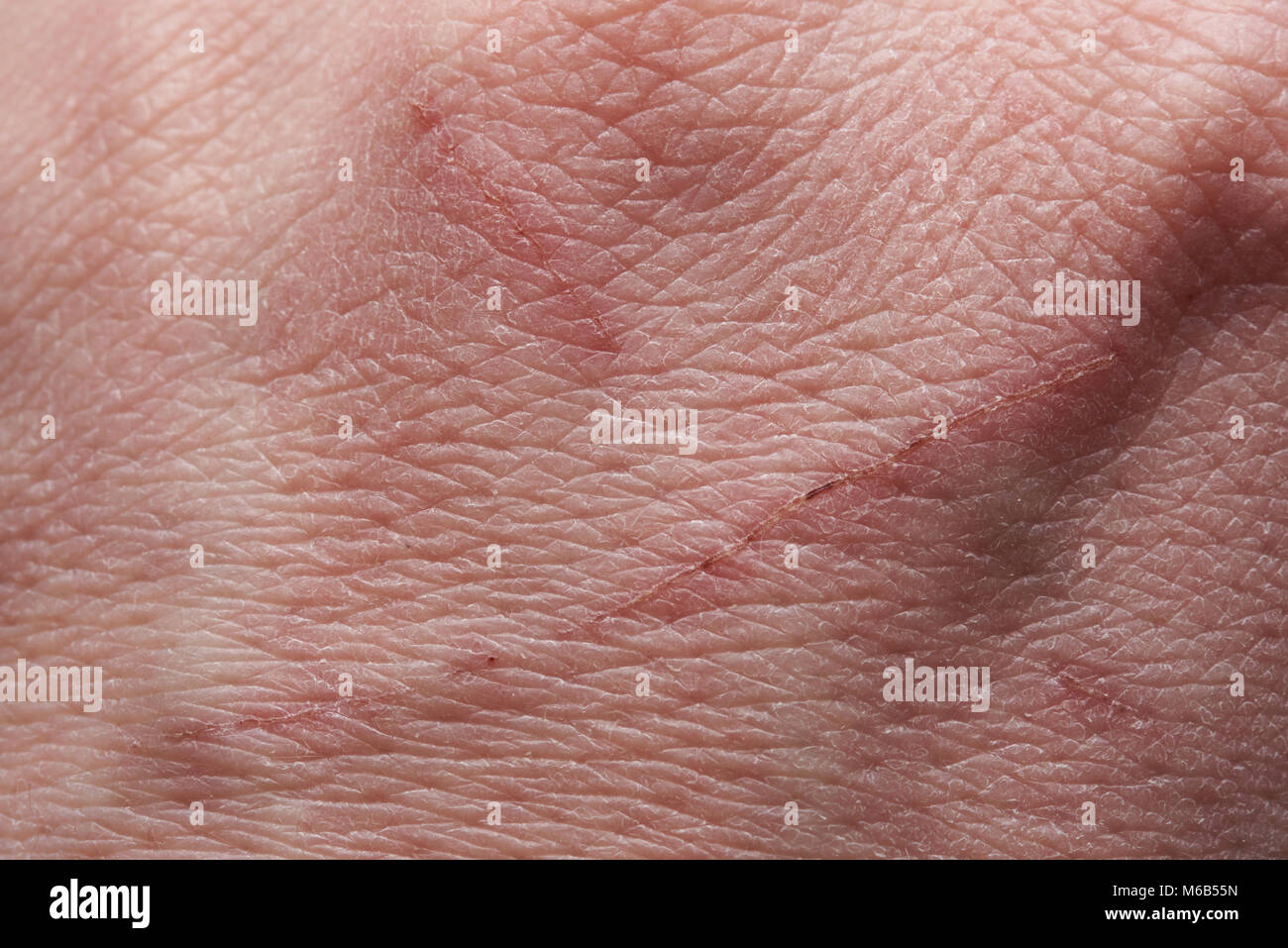 Damaged with scratch caucasian human skin macro close up Stock Photo ...