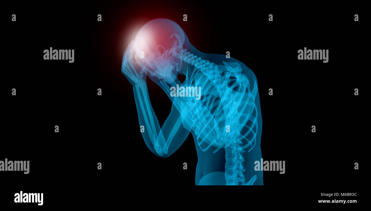 3d migraine headache xray hi-res stock photography and images - Alamy