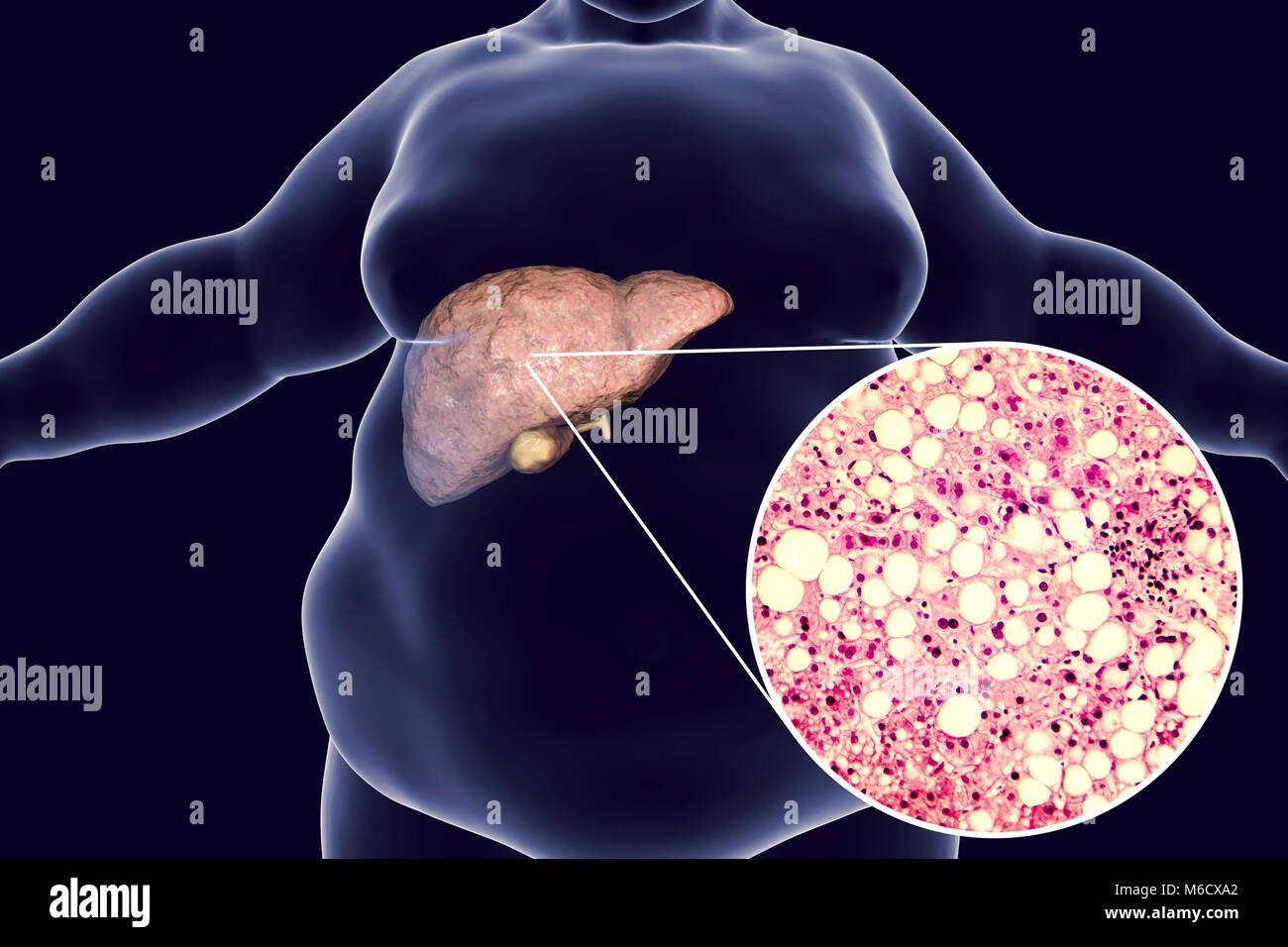 Fatty liver in obese person, illustration and micrograph. Fatty liver ...