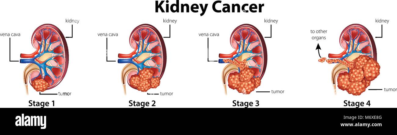 Kidney Cancer Stages Renal Cell Carcinoma: Diagnosis, Staging, And