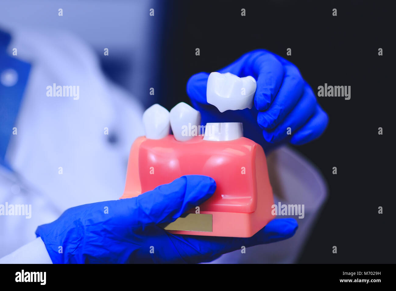 Dental implant in the hands of real doctor - model of teeth in closeup ...