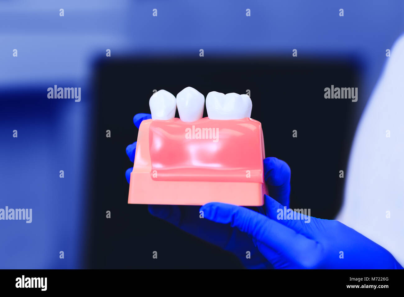 Model of teeth with dental implant in the hands of real doctor, closeup ...