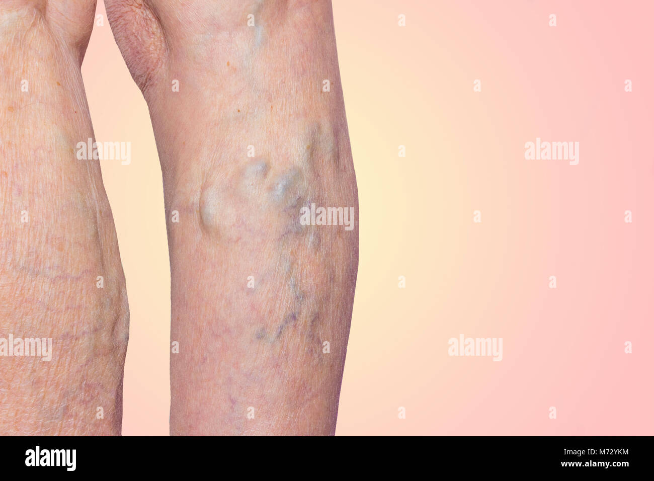 The varicose veins on a legs of old woman on blue Stock Photo - Alamy