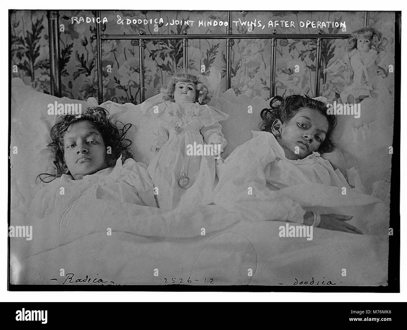 A photograph of Radica and Doodica, conjoined twins of Indian origin ...