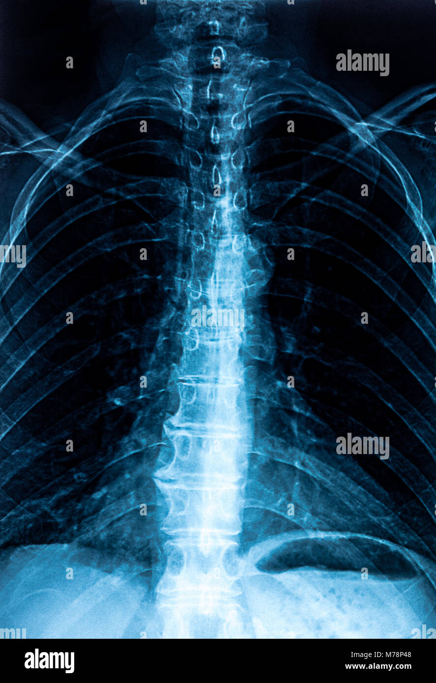 Woman Lumbar Spine X-ray, Lower Back Examination Stock Photo - Alamy