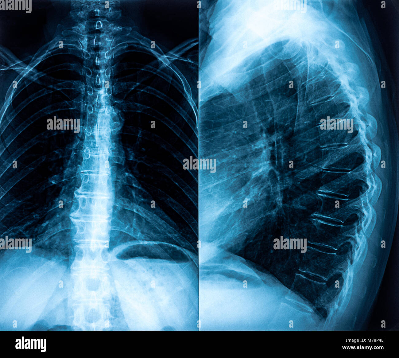 Woman Lumbar Spine X-ray, Back Examination Stock Photo - Alamy