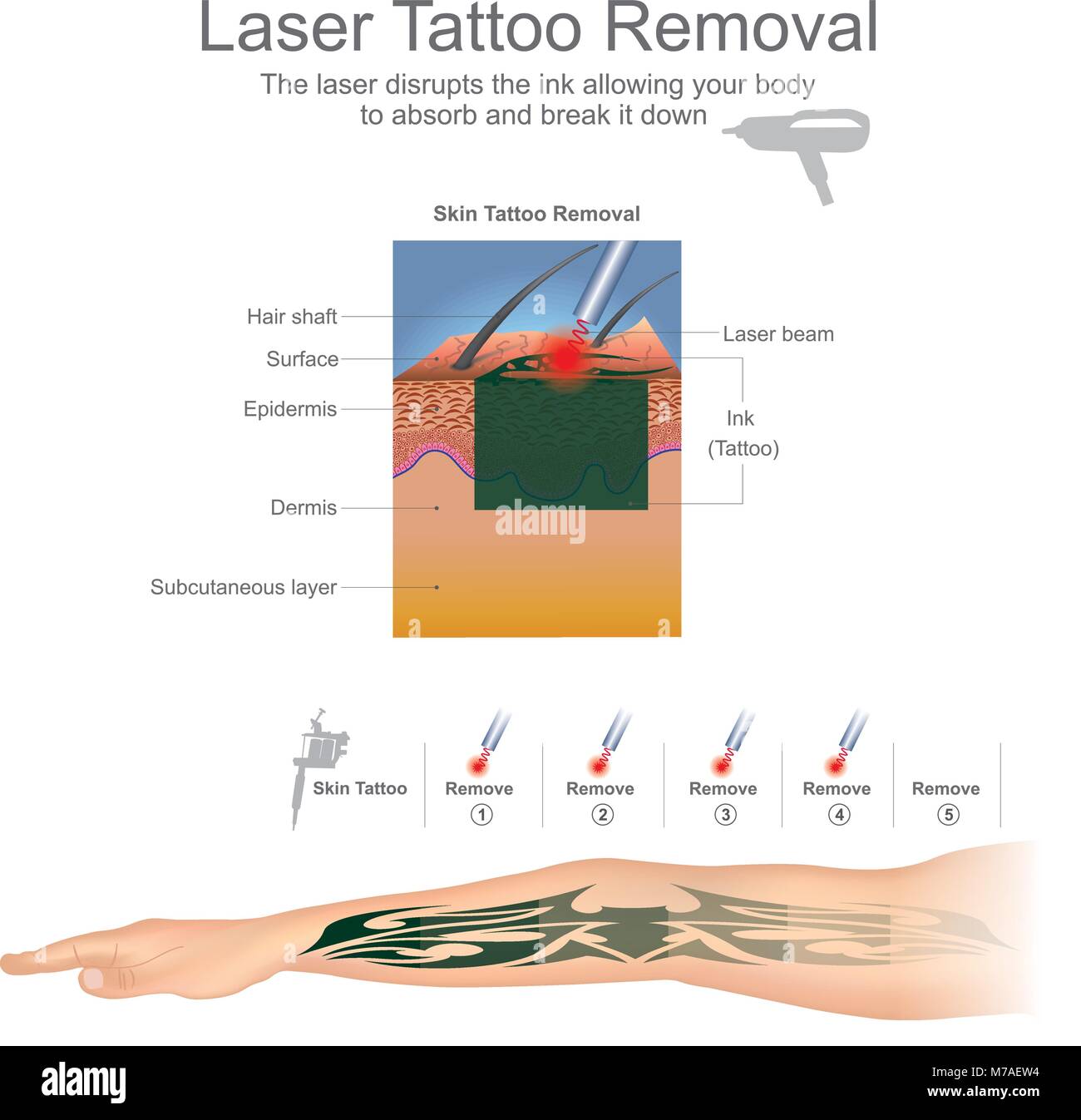 Tattoo removal is most commonly performed using lasers that break down ...