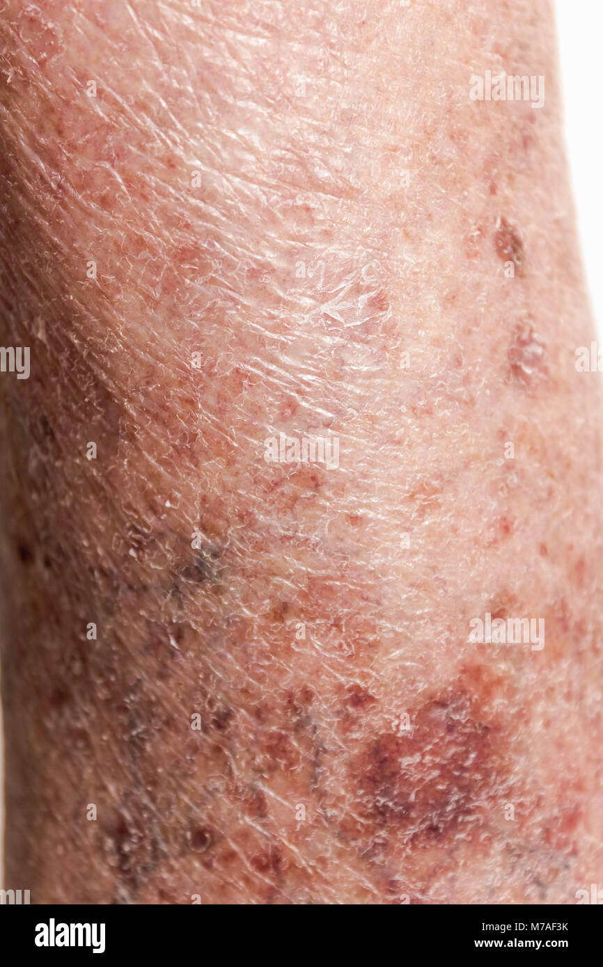 The skin with varicose veins Stock Photo - Alamy