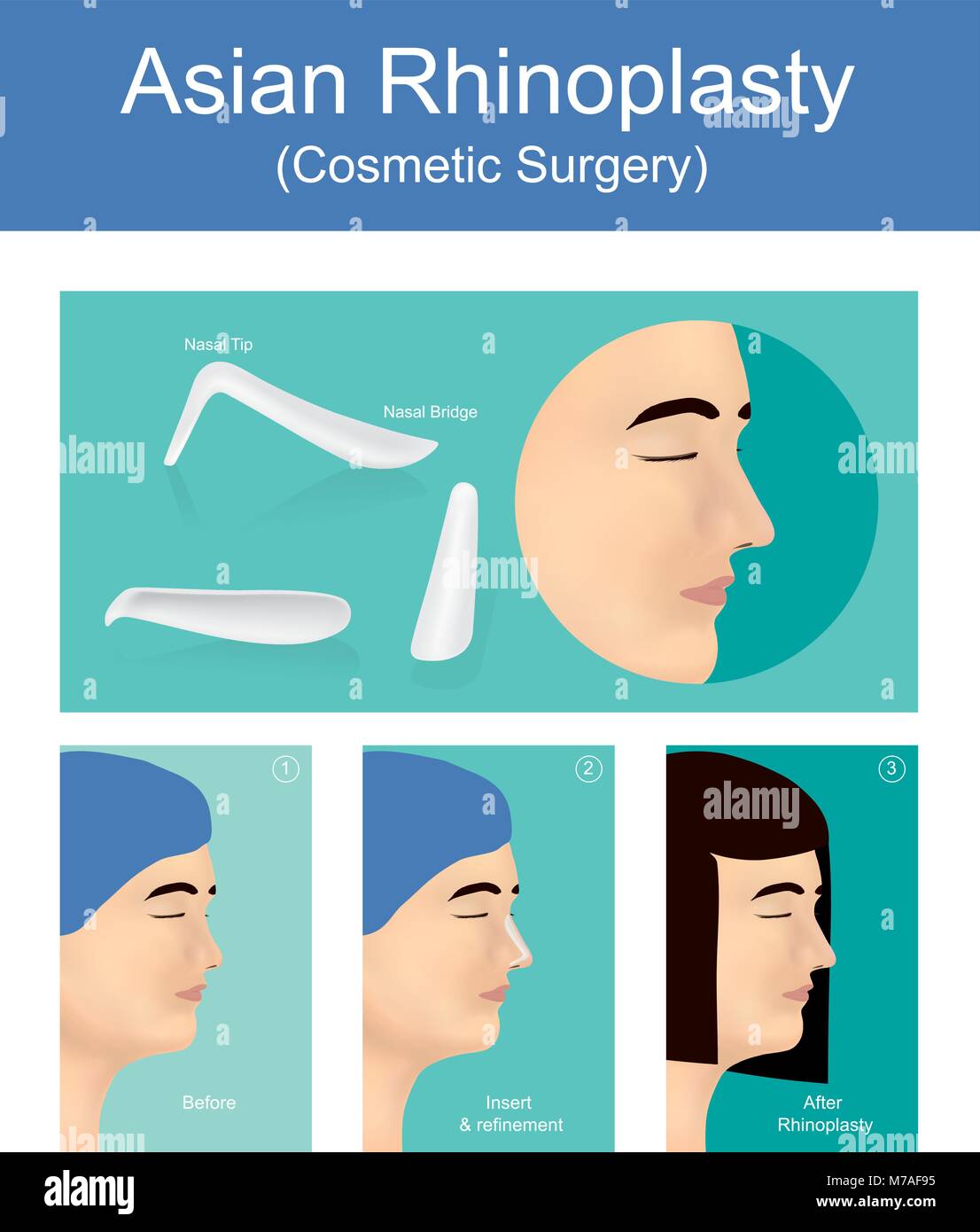 Rhinoplasty is a plastic surgery creates a aesthetic and facially ...