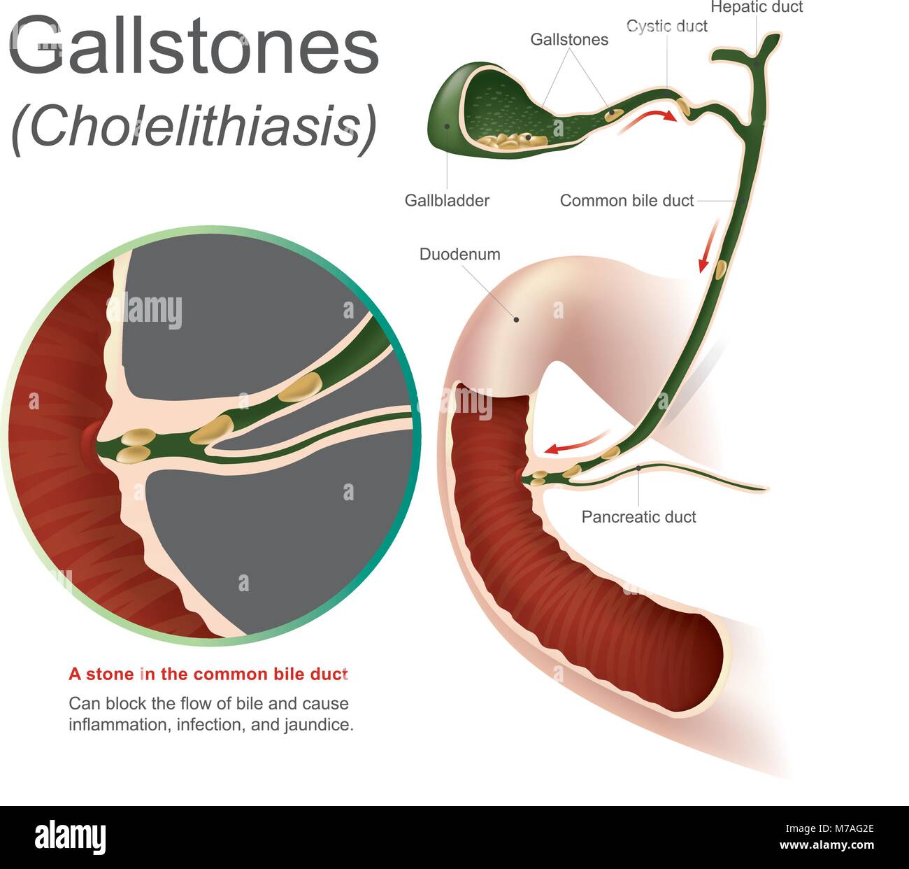 A stone in the common bile duct, gallstones can block the flow of bile ...