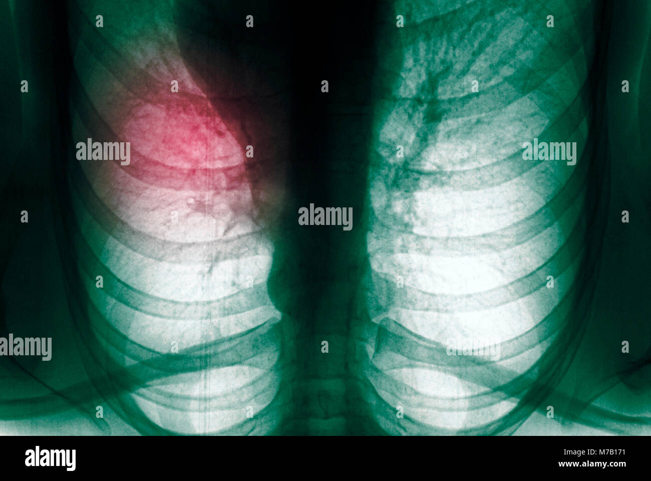 Damaged lungs hi-res stock photography and images - Alamy