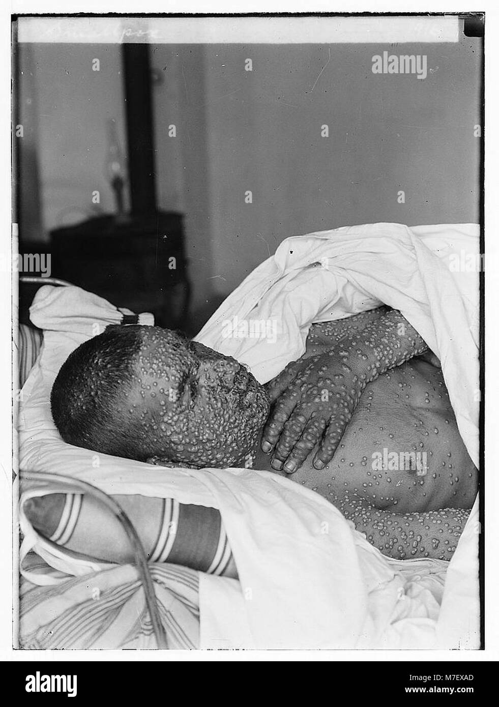 A historical document or photograph depicting the impact of smallpox ...