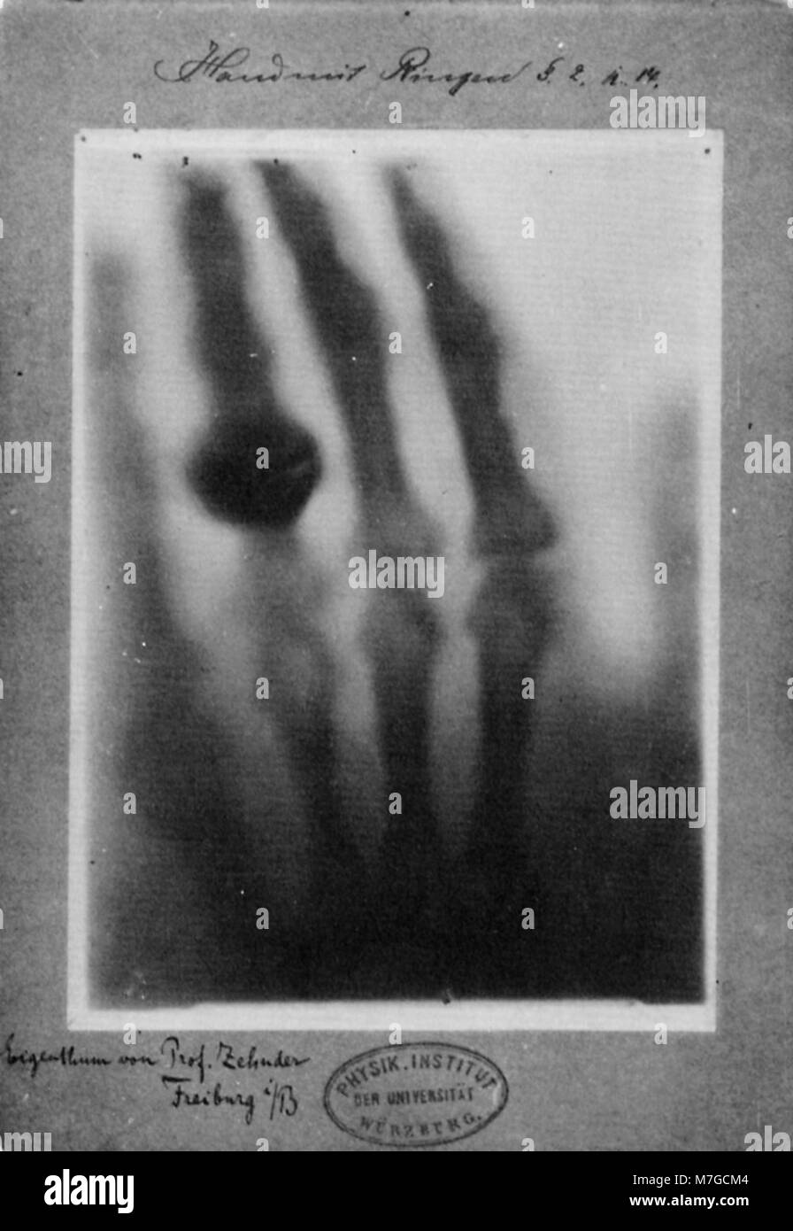 Wilhelm Conrad Röntgen's famous X-ray photograph of his wife’s hand ...
