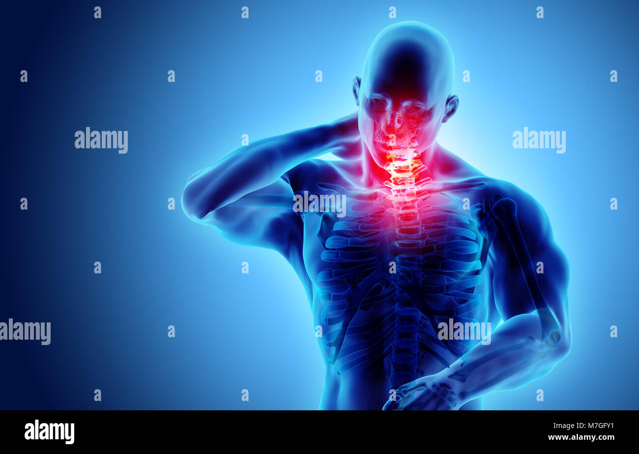 3D illustration, neck painful - cervical spine skeleton x-ray, medical ...
