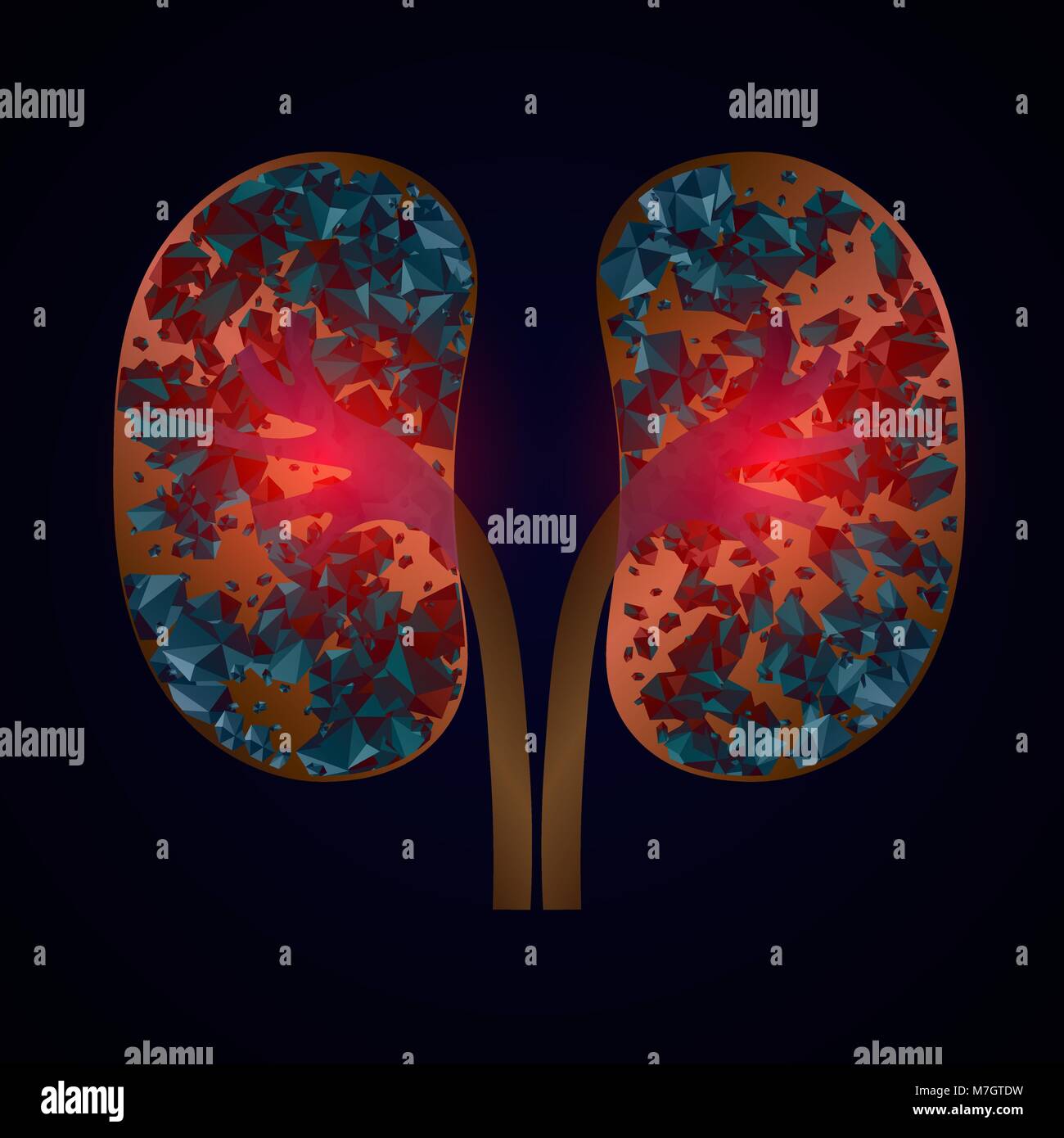 Nephrolithiasis kidney stones disease. Vector medical illustration ...