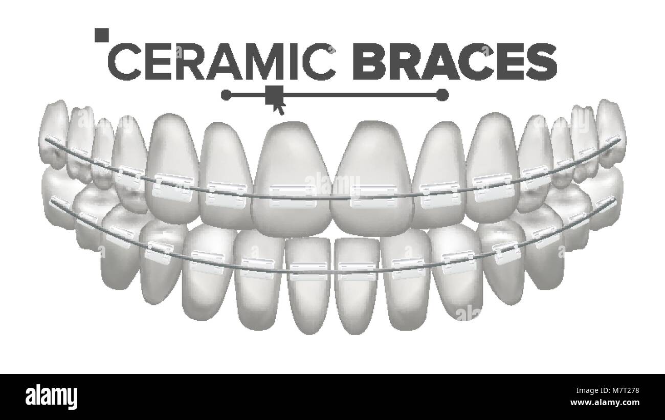 Ceramic Braces Vector. Human Jaw. Dentist, Orthodontist Poster Element ...