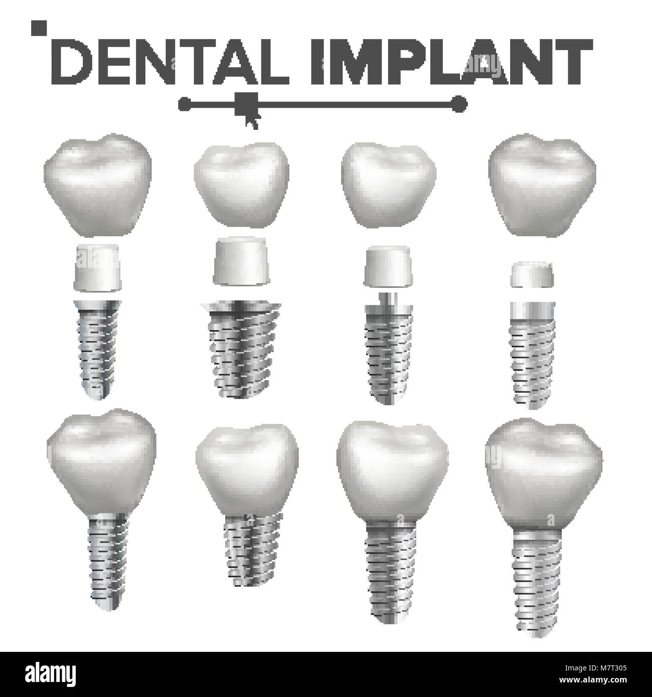 Dental Implant Set Vector. Dental Clinic Stomatology Flyer. Health ...