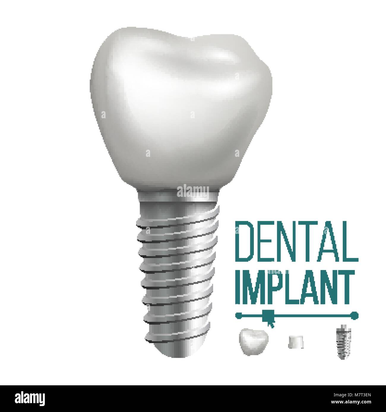Dental Implant Vector. Molar Human Teeth. Dental Clinic Stomatology ...