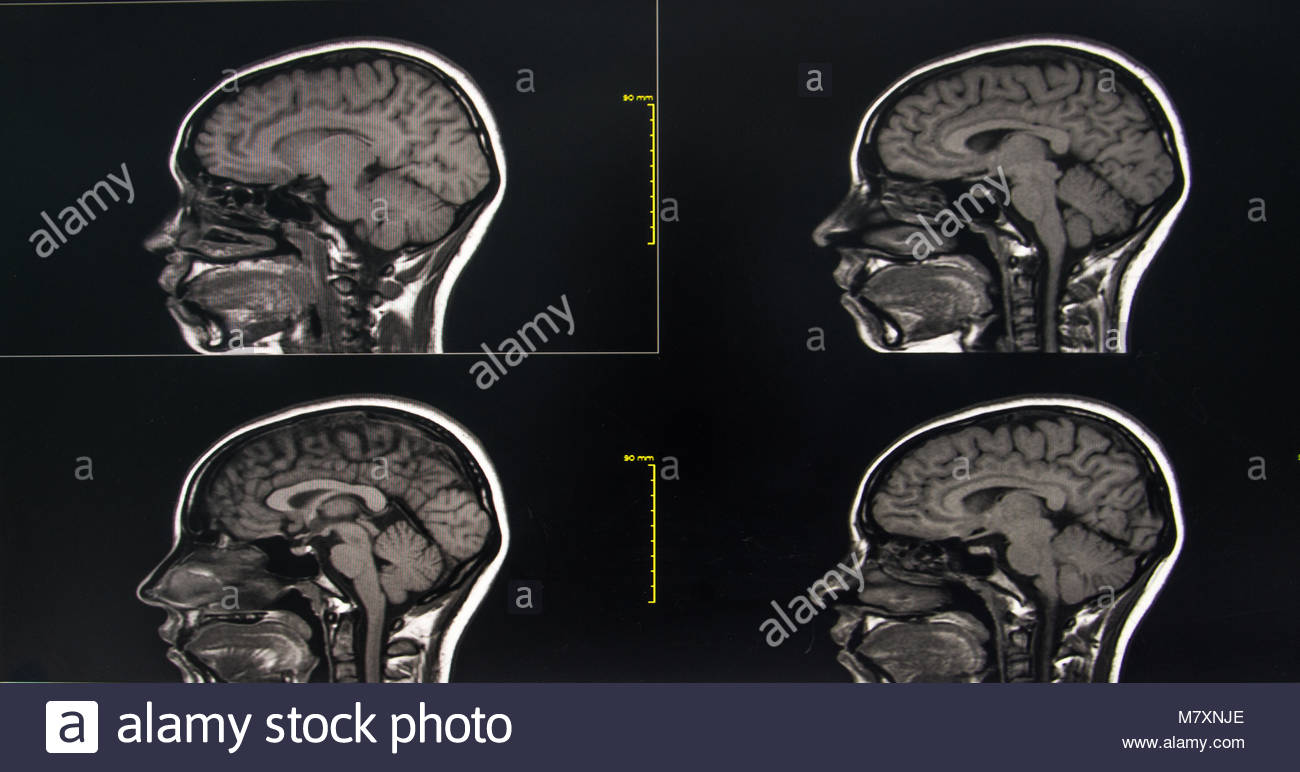 Brain Hemorrhage Stock Photos & Brain Hemorrhage Stock Images - Alamy