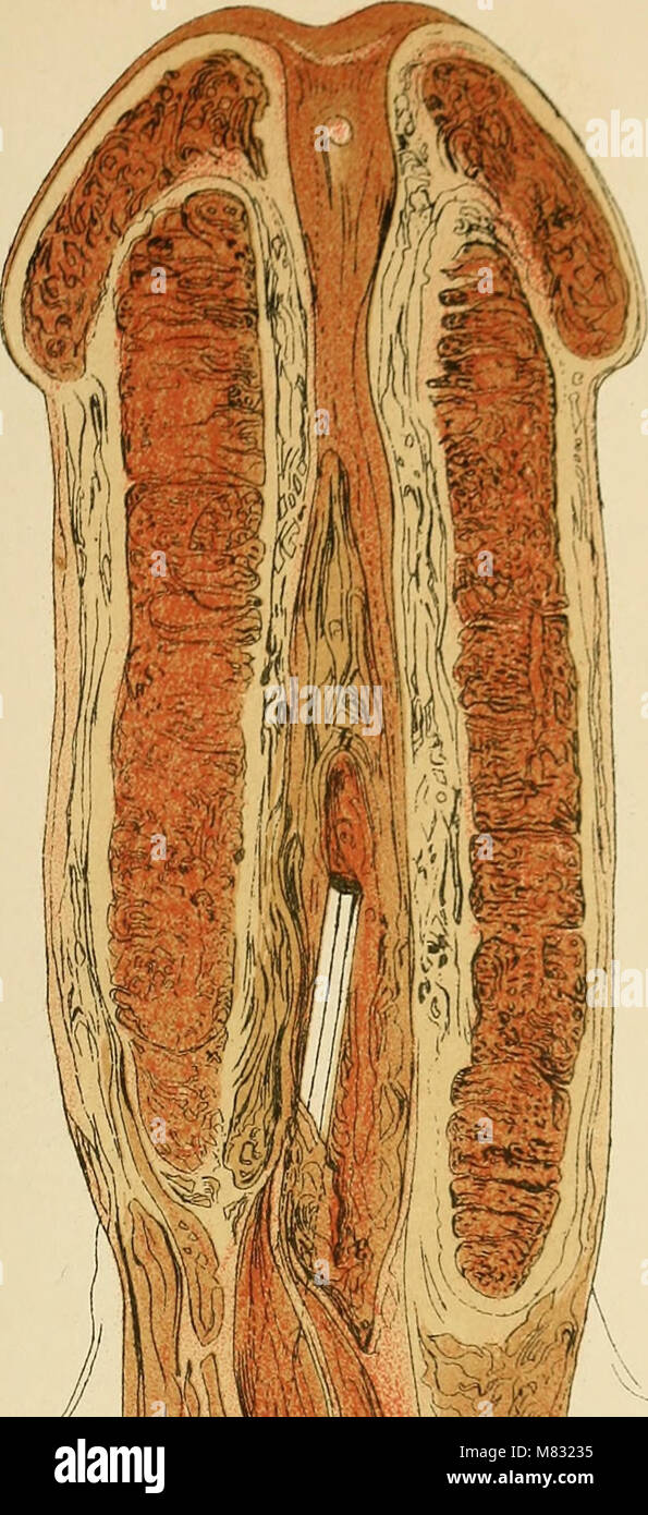 Clinical lectures on stricture of the urethra and other disorders of ...