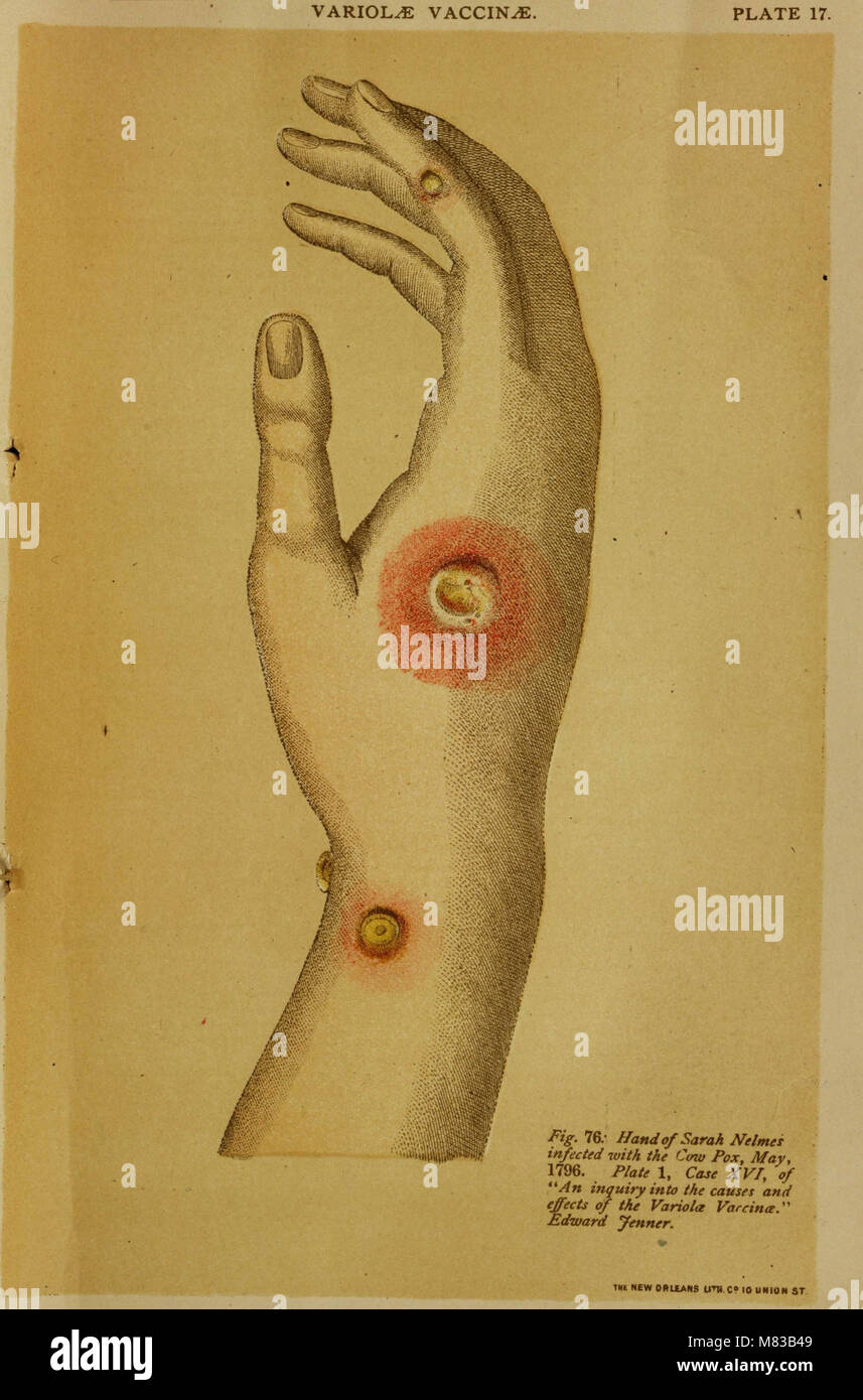 Cow pox hi-res stock photography and images - Alamy