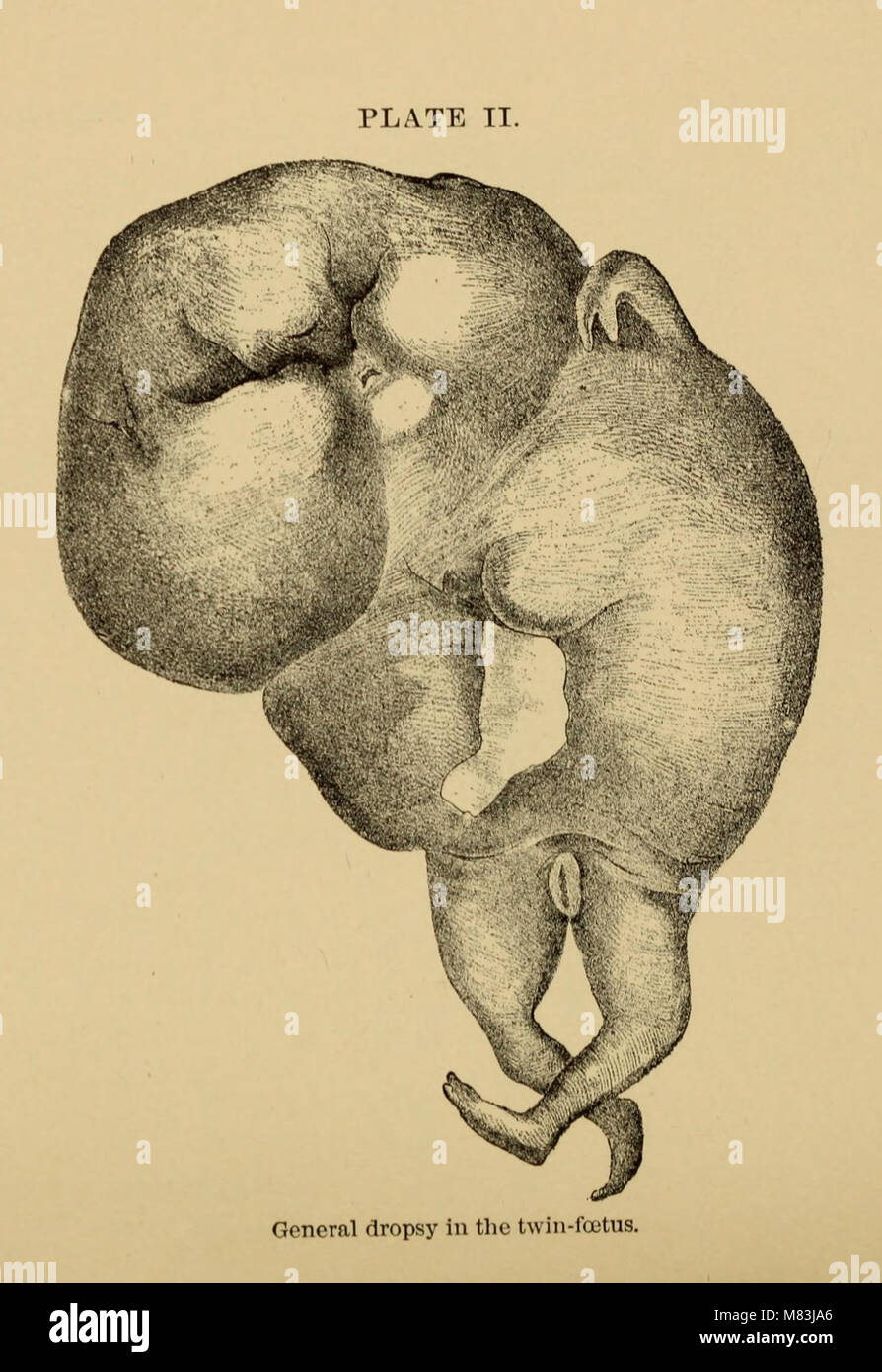 The 1889 'Cyclopaedia of the Diseases of Children' provides an ...