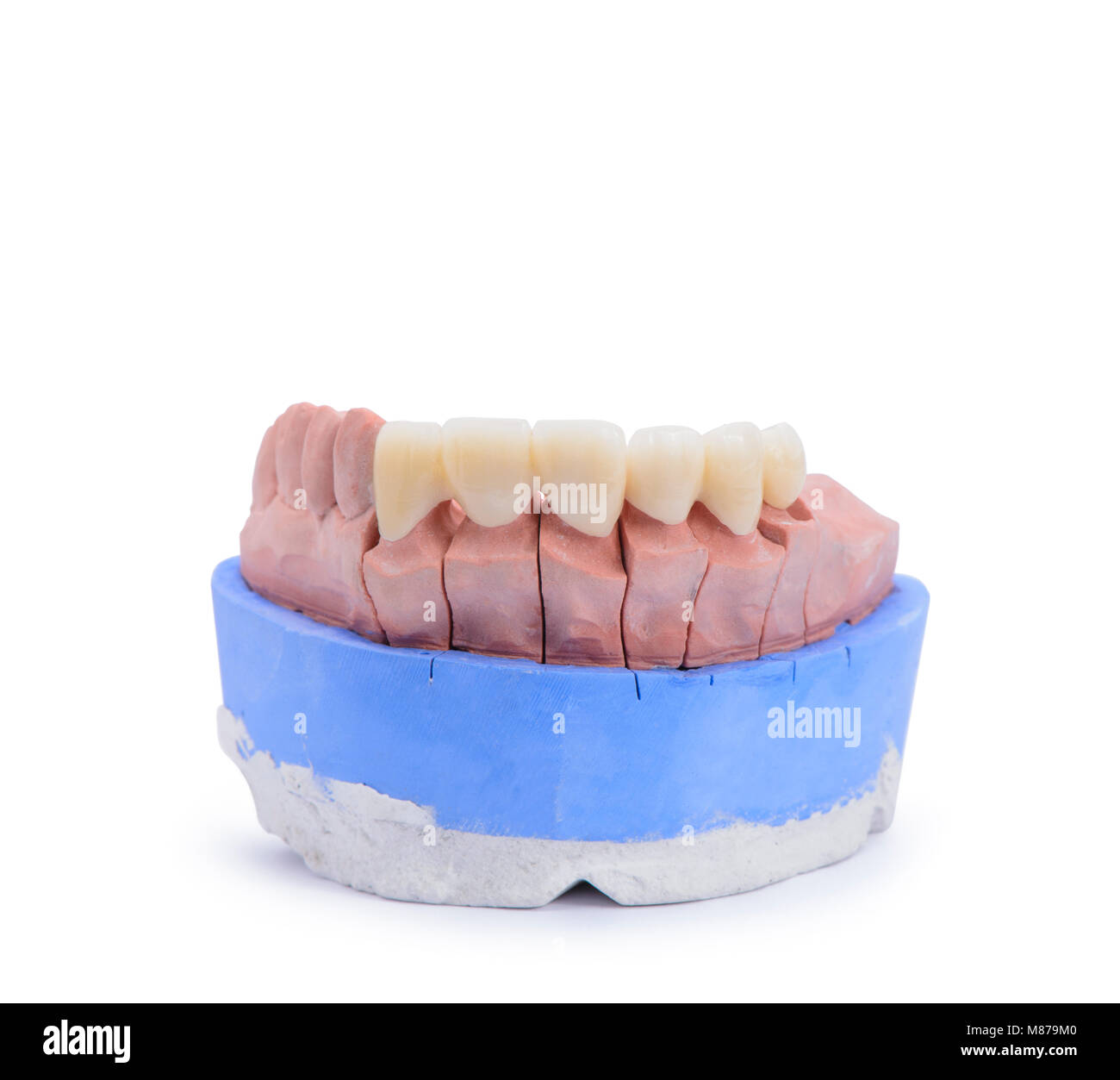 All ceramic highly aesthetic dental bridge and crown on gypsum model ...