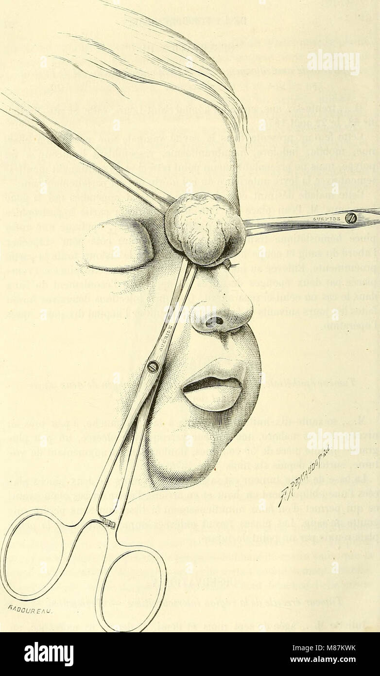 This 1877 French work discusses the technique of vessel compression as ...