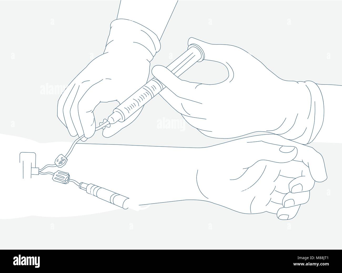 Mono line illustration of a diagram illustrating infusion therapy by ...