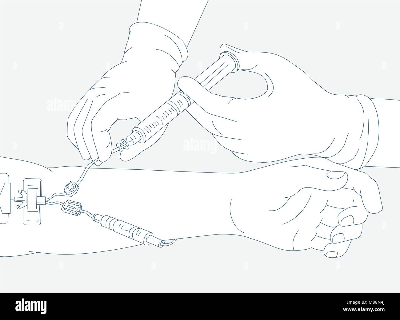 Mono line illustration of a diagram illustrating infusion therapy by ...
